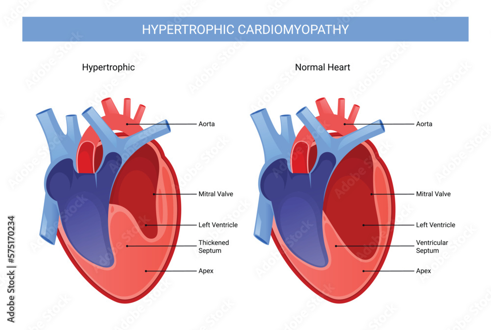 Vetor de Hypertrophic cardiomyopathy infographic do Stock | Adobe Stock