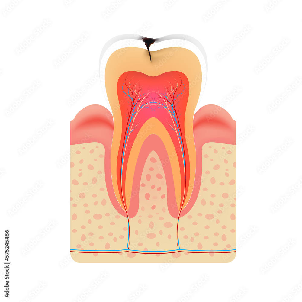Tooth caries stages, development of teeth decay with enamel and dentin ...