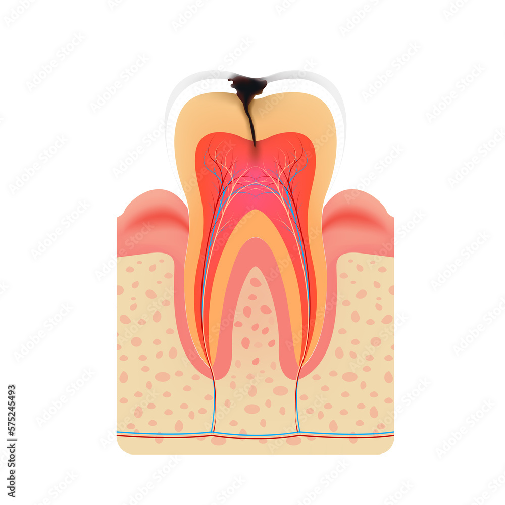 Tooth black, development of teeth decay with enamel and dentin caries ...