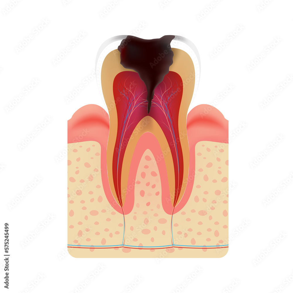 Tooth caries stages, development of teeth decay with enamel and dentin ...