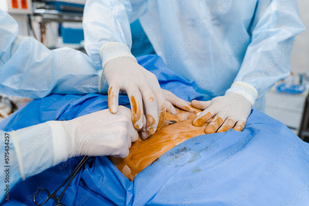 Foto de Surgeon is removing fat in abdomen close-up. Abdominoplasty ...