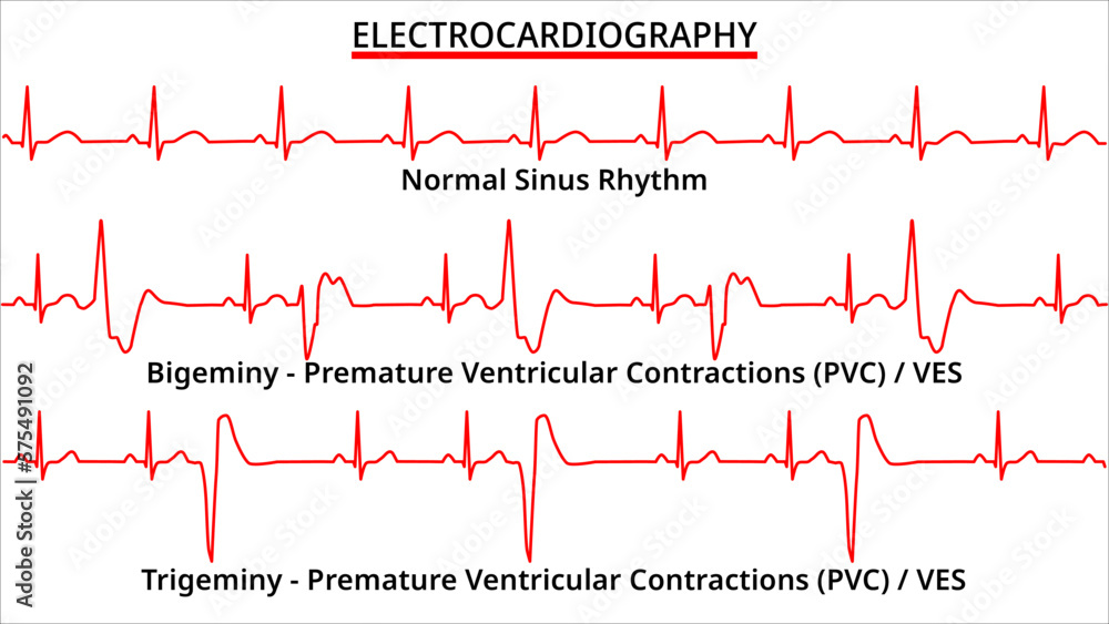 Poster Set Of ECG Common Abnormalities Bigeminy Vs Trigeminy Poster Set Of ECG Common Abnormalities Bigeminy Vs Trigeminy