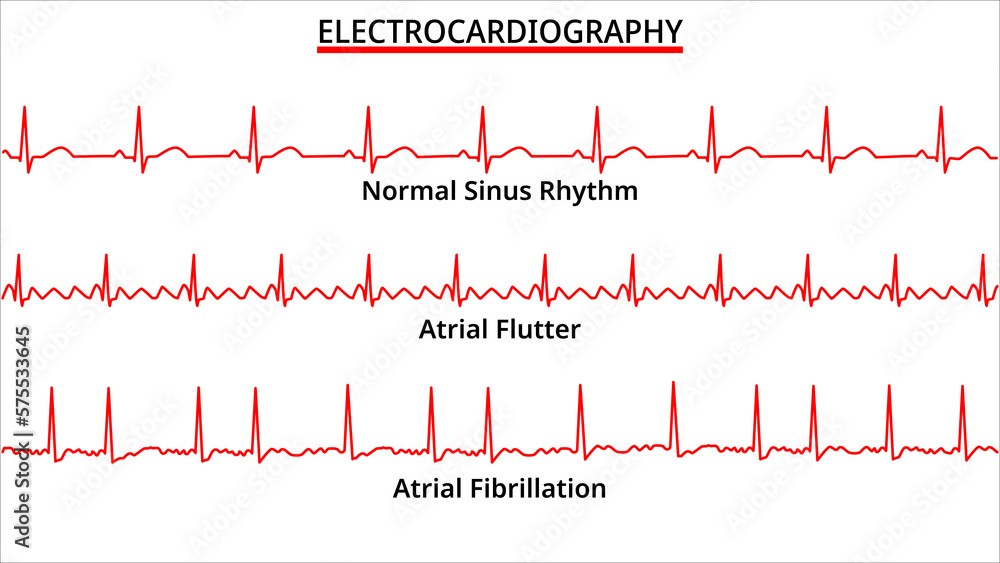 Set Of Ecg Common Abnormalities Atrial Flutter Vs Atrial Fibrillation Normal Sinus Rhythm