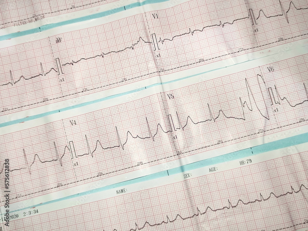 Hyperacute T Wave On Anterior Wall That Usually Indicates Ischemia Or Hyperkalemia Or Potassium