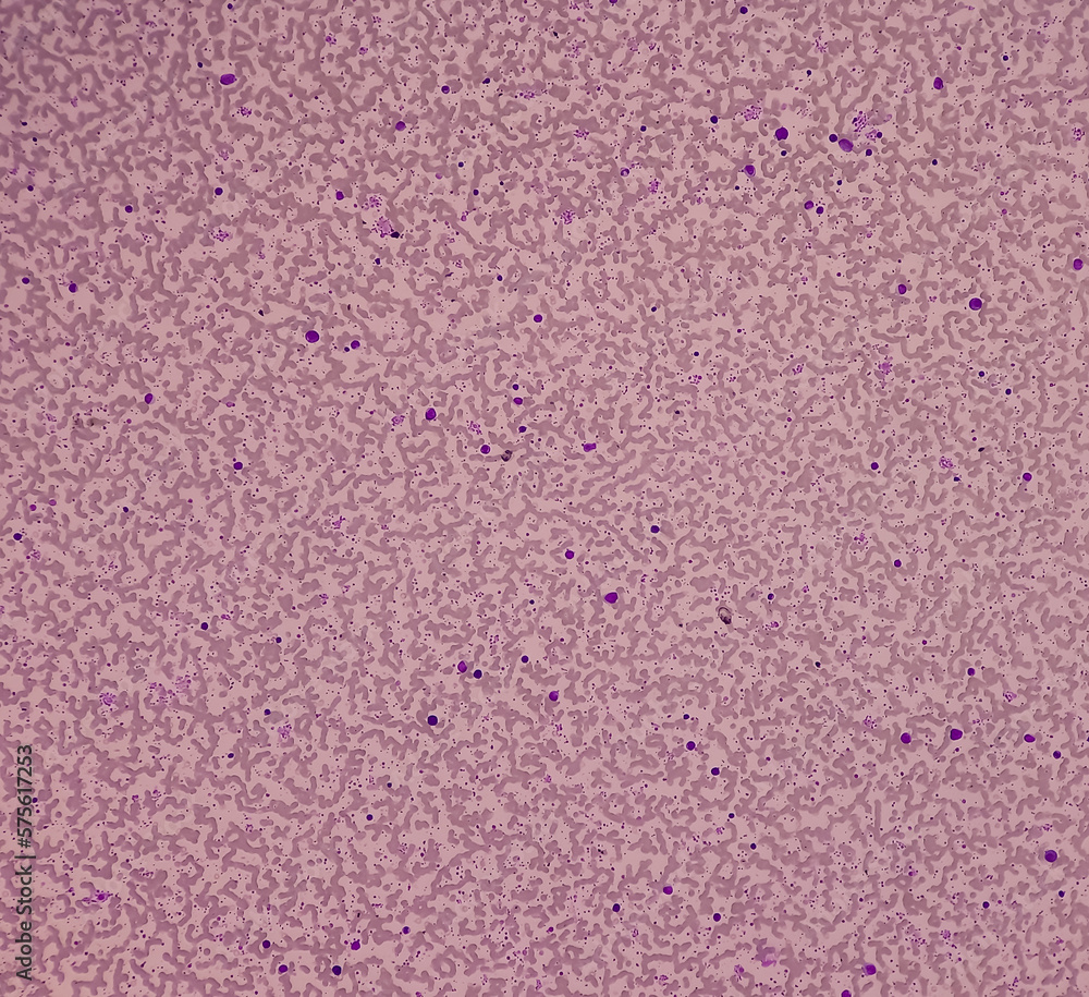 Chronic myeloid leukemia (CML) in accelerated phase also known as ...