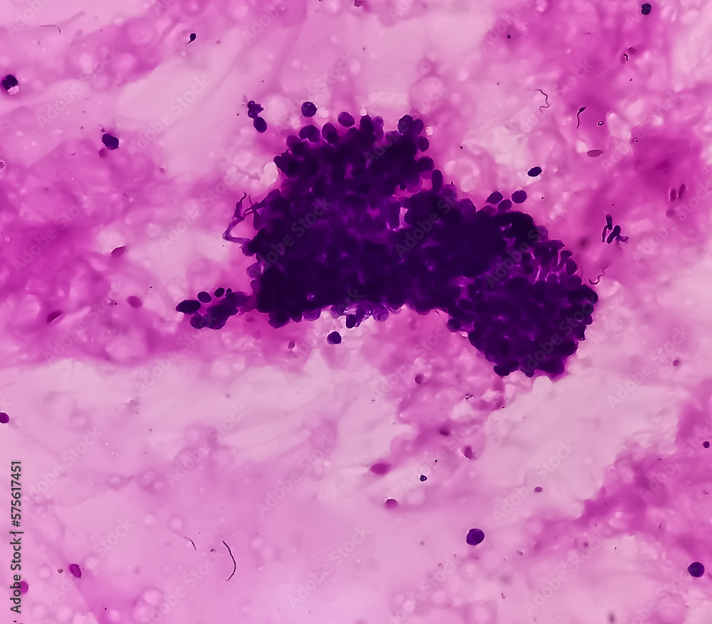Tumor of temporal region(FNA cytology). Benign adnexal tumor. Smear ...
