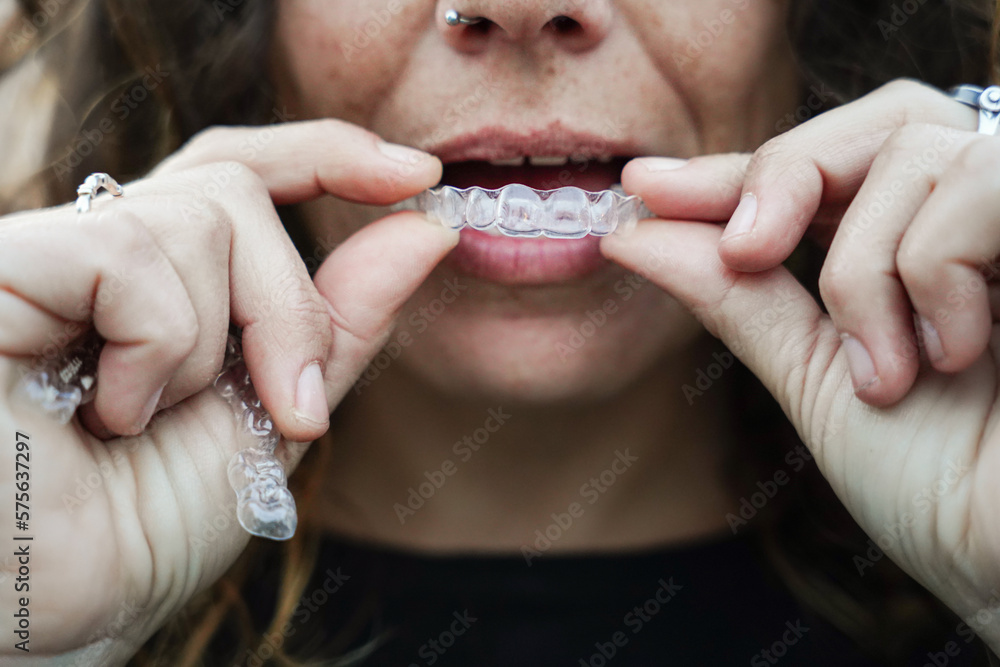 unrecognizable woman putting on an invisible teeth brace. aesthetic ...