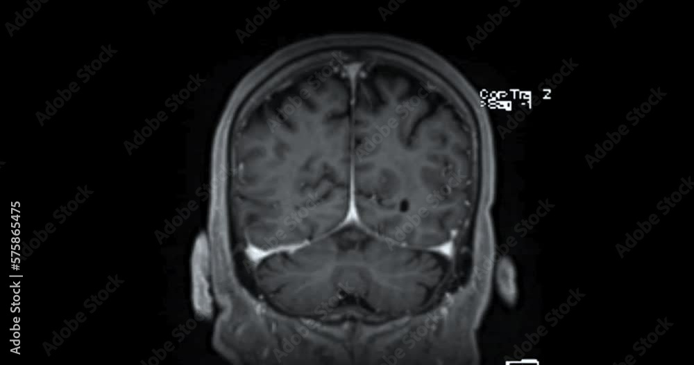 MRI Brain can help doctors look for conditions such as bleeding ...