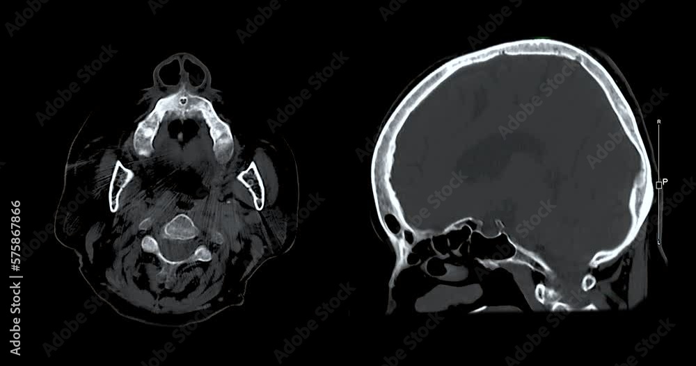 Video „CT scan of the brain for diagnosis brain tumor,stroke diseases ...