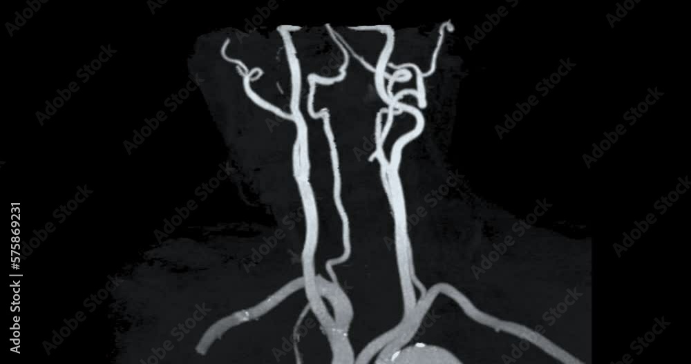 Contrasted of MRA Carotid artery Coronal MIP view showing common ...