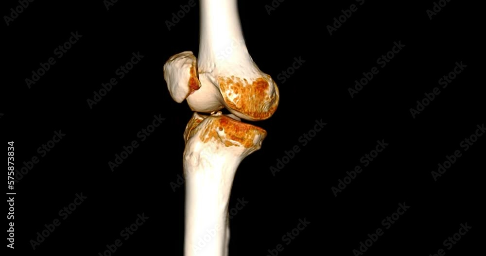 CT Scan of Knee joint 3D rendering showing fracture of lateral condyle ...