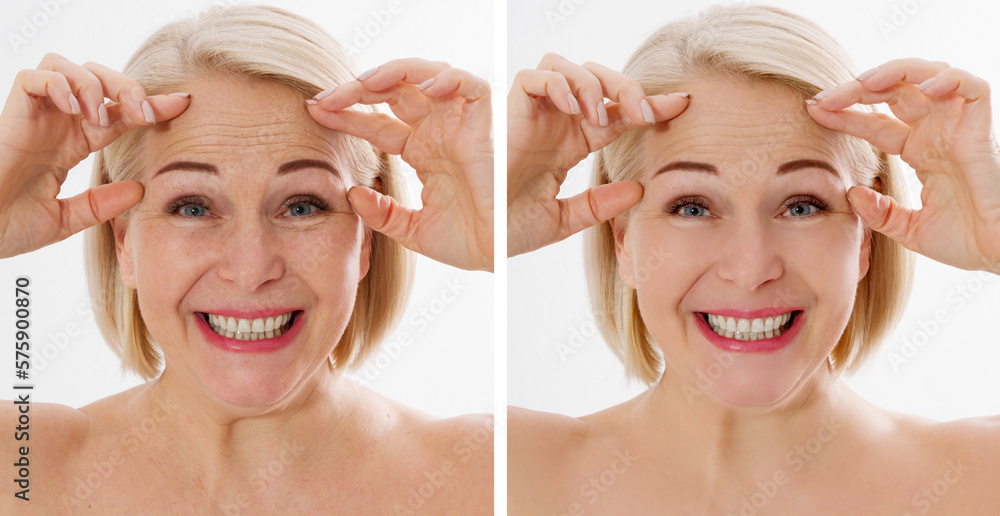 Banner Before-after Macro Woman face with wrinkles on the forehead ...
