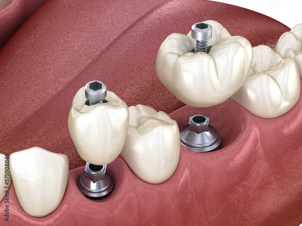 Premolar and Molar tooth crown installation over implant, screw ...