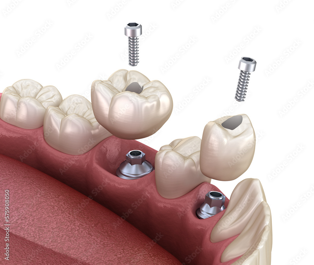 Premolar and Molar tooth crown installation over implant, screw ...