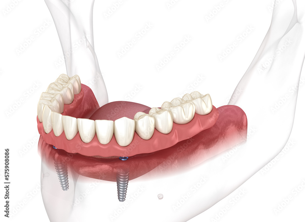 Mandibular removable prosthesis All on 2 system supported by implants ...