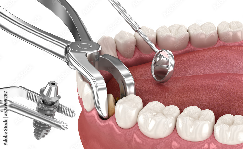 Tooth extraction and implantation, complex immediate surgery. Dental 3D ...