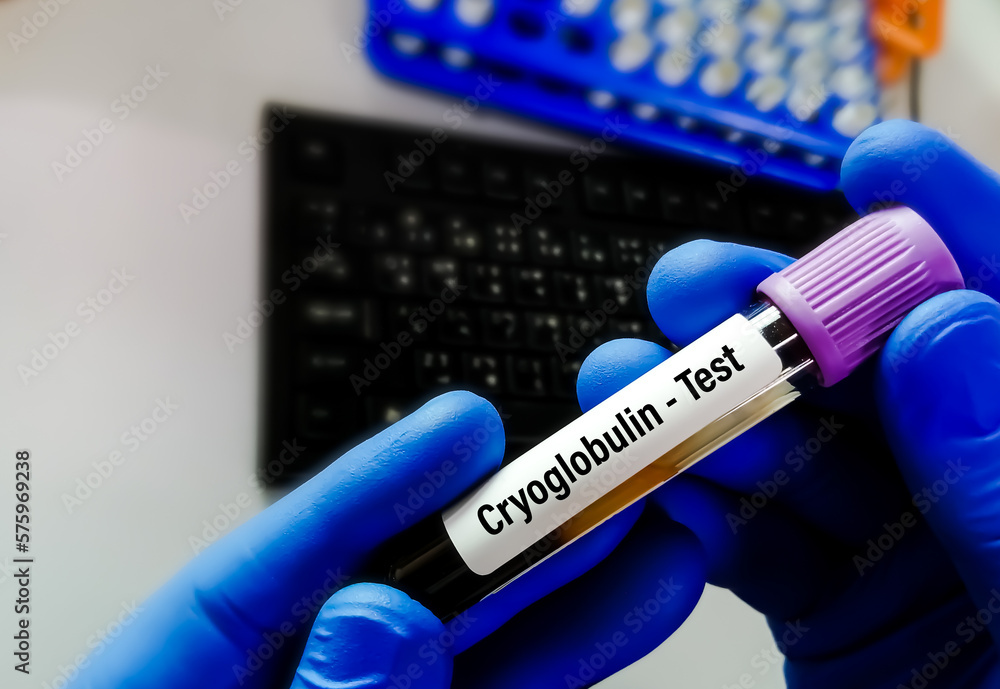 Foto de Blood sample for Cryoglobulin test, to diagnose abnormal ...