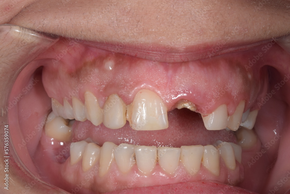 Open mouth dentistry patient with esthetical condition edentulous ...