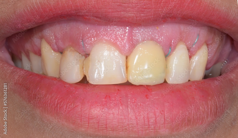 Frontal view of a woman mouth smiling with fake teeth of porcelain ...