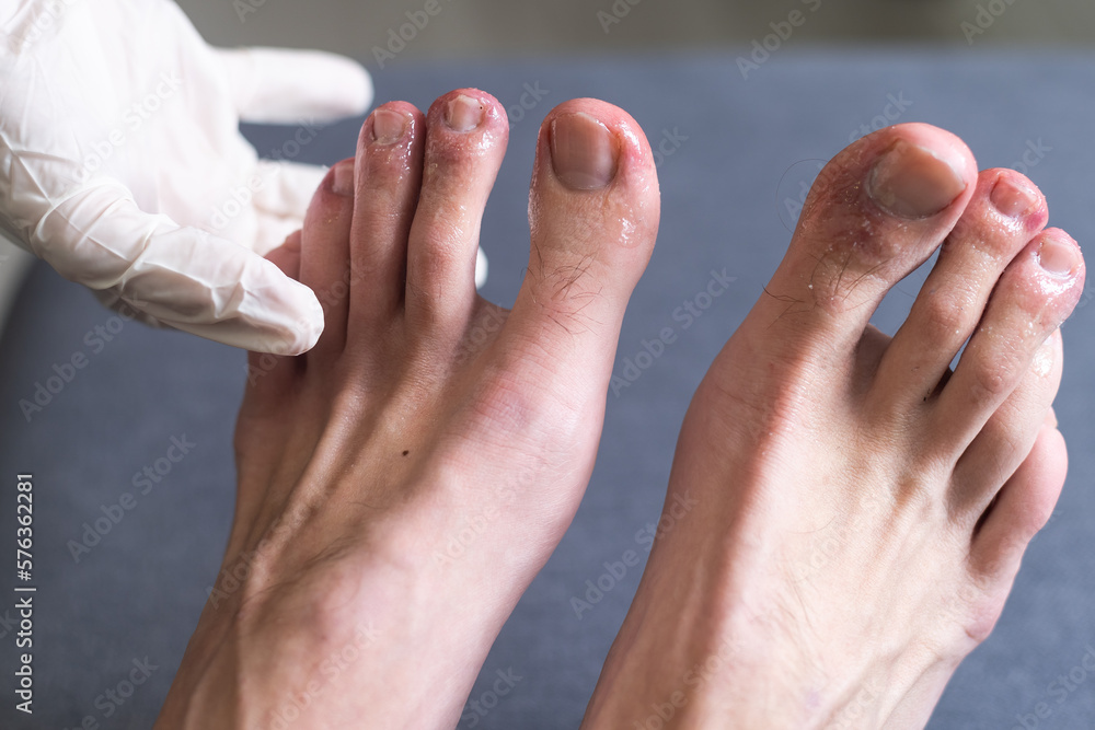 A man's toes showing what looks like a rash with red blotchy skin. A ...
