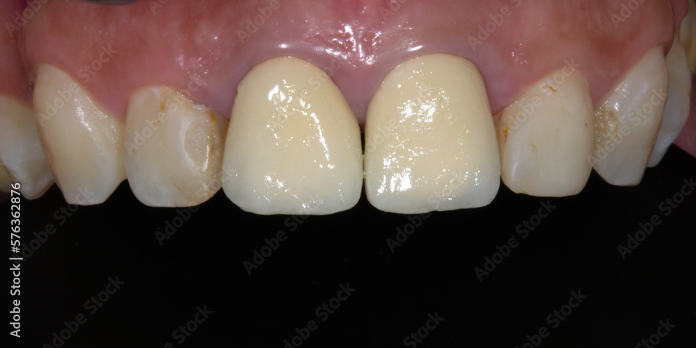 Frontal view of maxillary arch incisor and canine teeth and fixed ...