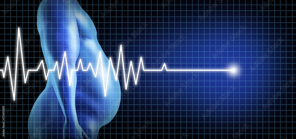 Obesity death risk and premature deaths caused by being overweight as a ...