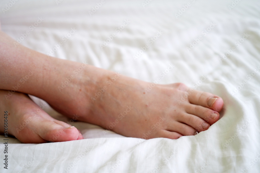 Foto de female legs with problem with women's feet, bunion toes in bare ...