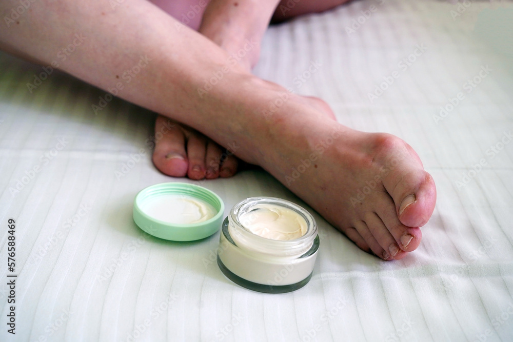 female legs with problem with women's feet and cream cosmetic, bunion ...