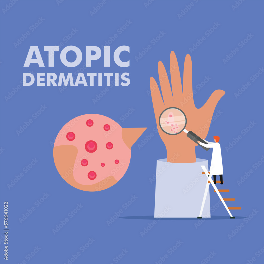 Vetor de Dermatologist and Big Hand with Red Skin and Rash 2d vector ...