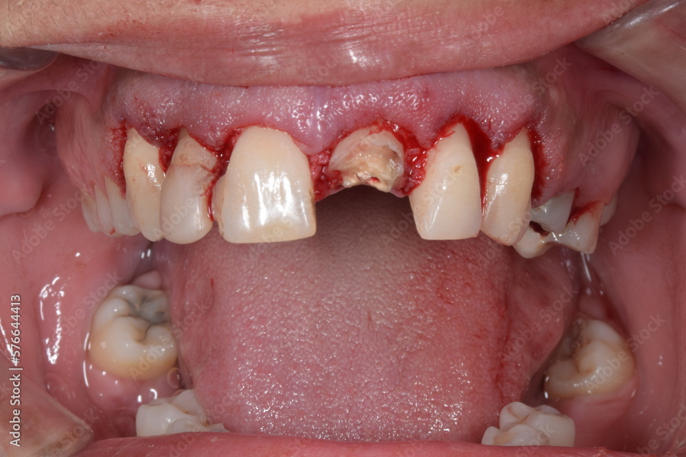 Open mouth dentistry patient with esthetical condition in central ...