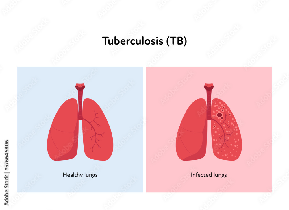 Tuberculosis Lungs Vs Healthy Lungs