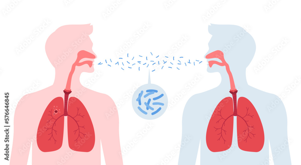 Tuberculosis disease concept. Vector flat healthcare illustration ...