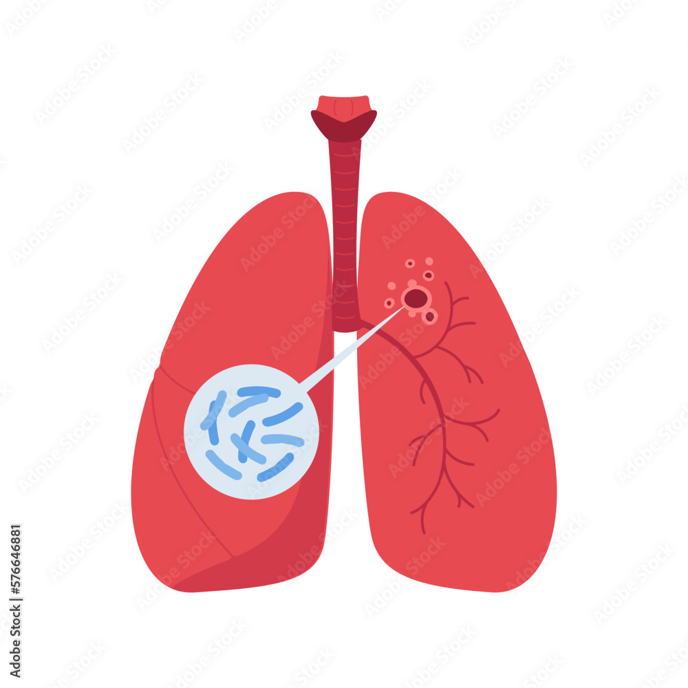Tuberculosis disease concept. Vector flat healthcare illustration. Red ...