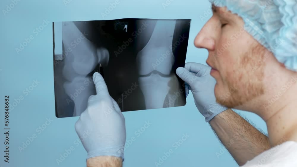 Doctor with knee x-ray. The doctor carefully analyzes a person's knee ...