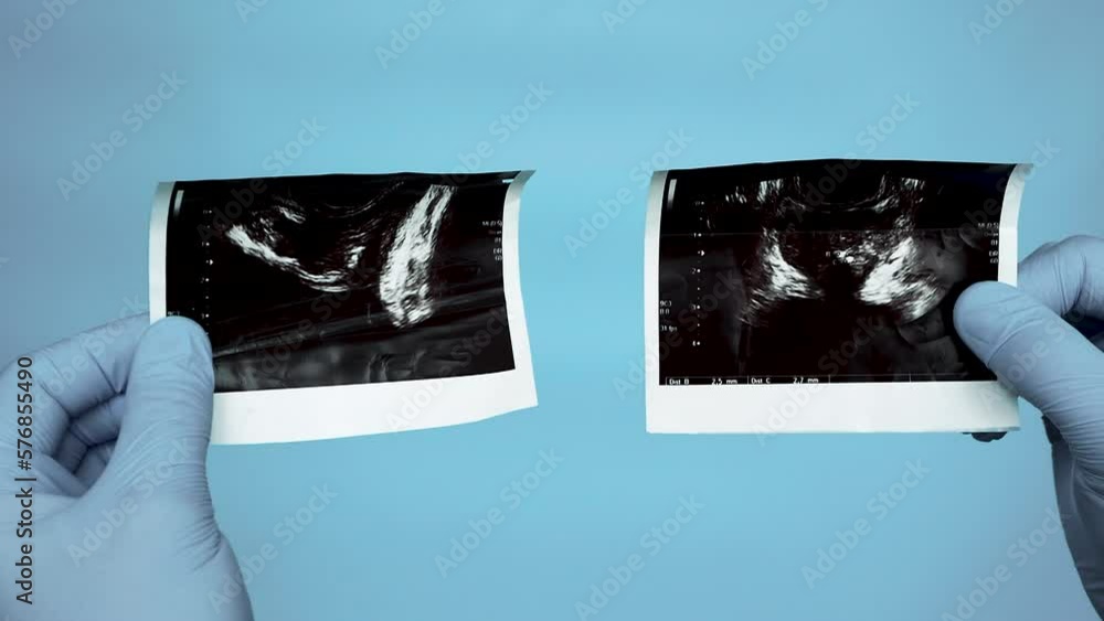 Close-up ultrasound, Doctor in sterile gloves, ultrasound of the ...