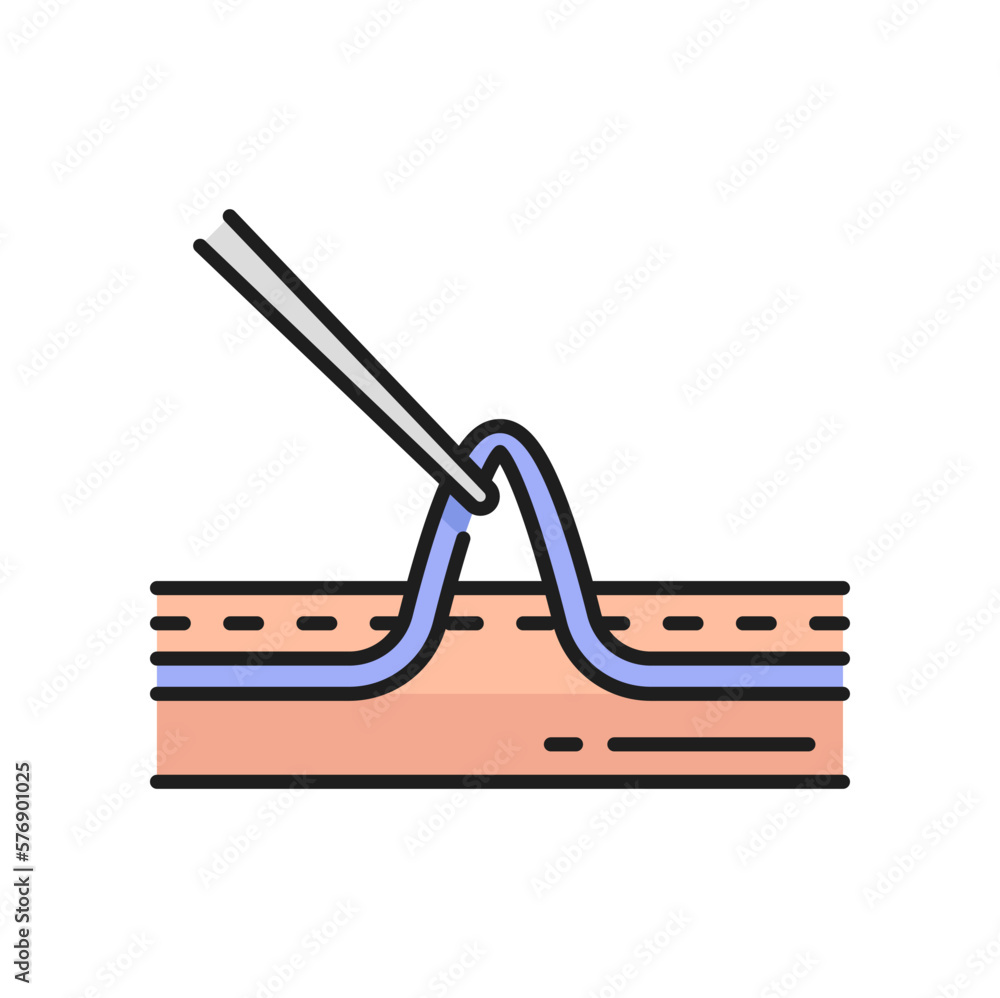 Sclerotherapy surgery, injecting solution in vein through catheter ...
