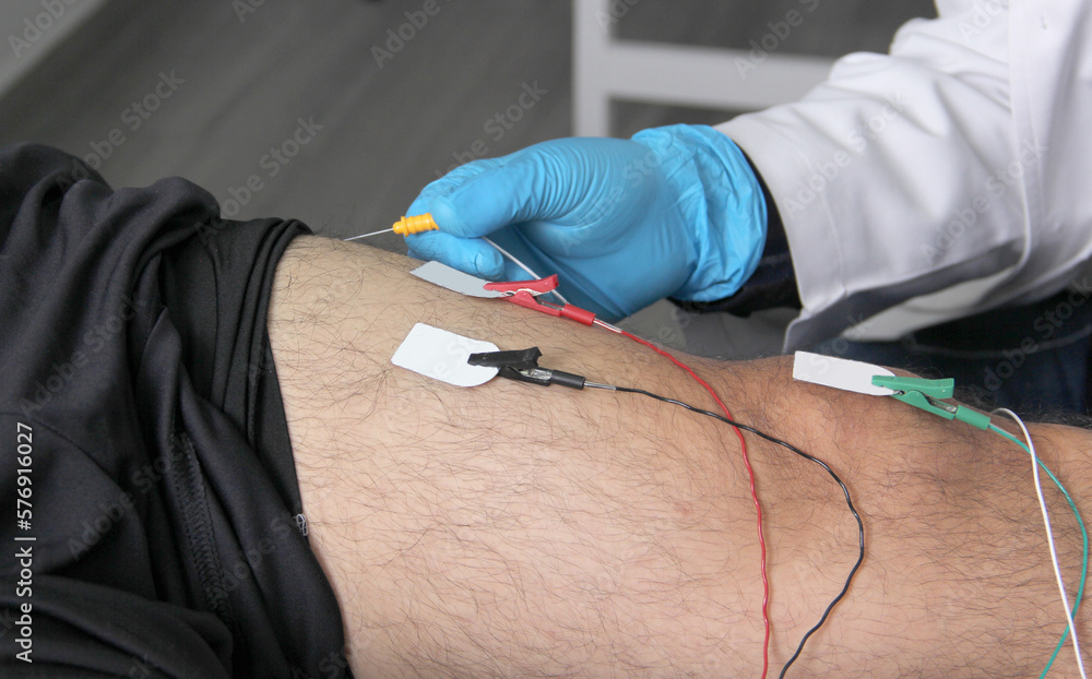Electromyography EMG and Somatosensory Evoked Potential PEV of lower ...