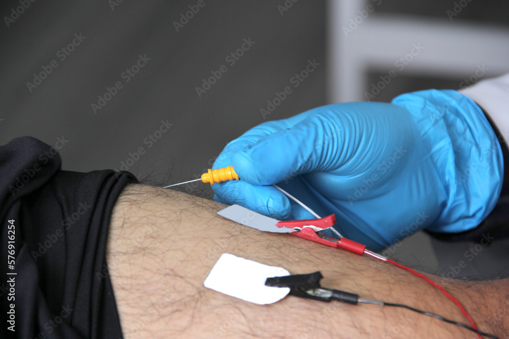 Electromyography EMG and Somatosensory Evoked Potential PEV of lower ...