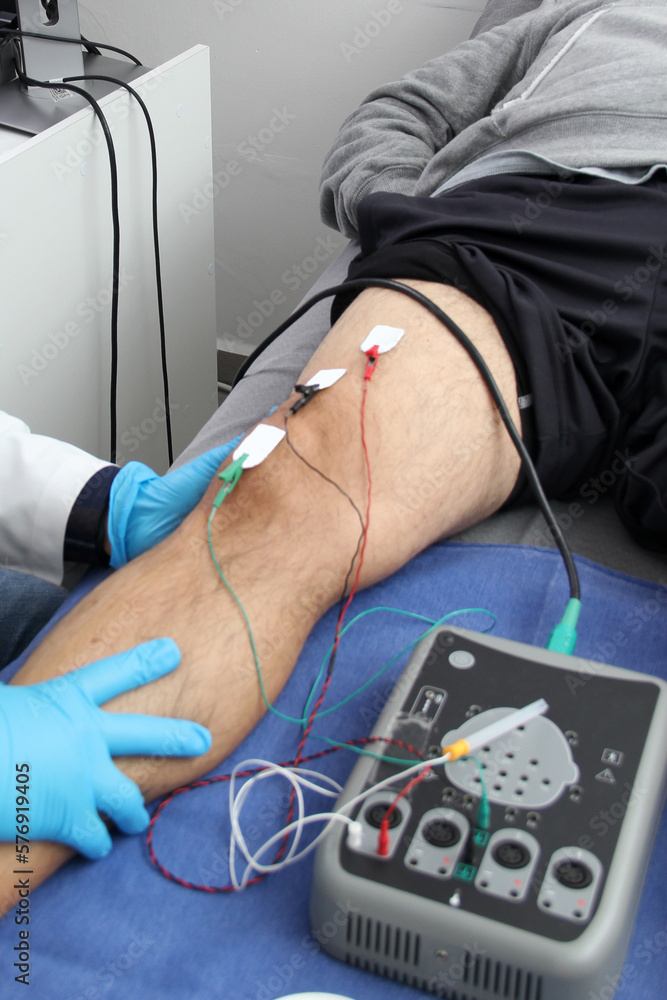 Electromyography EMG and Somatosensory Evoked Potential PEV of lower ...