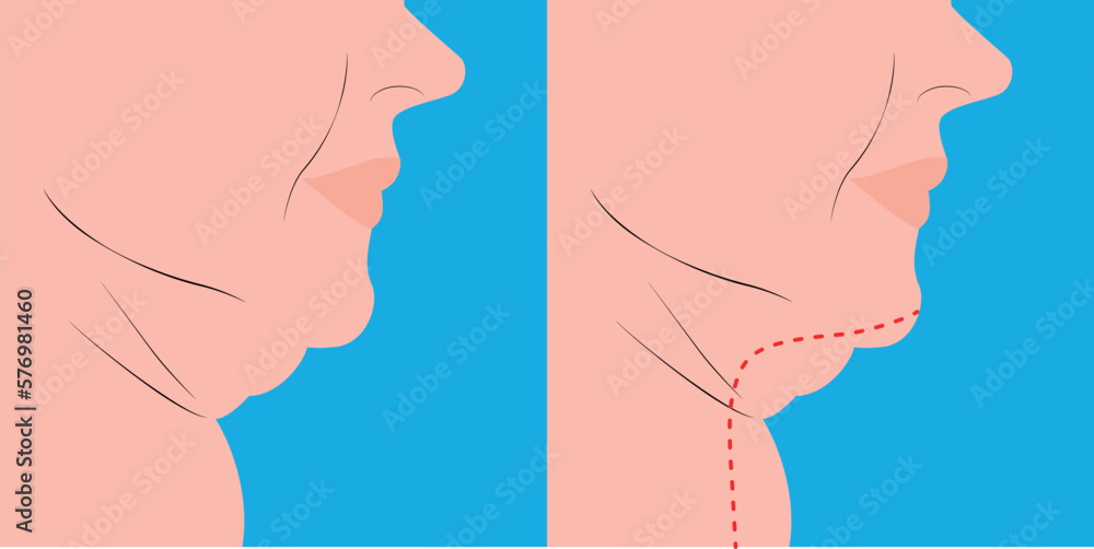 Fat double chin reducing, facelift before and after Stock Vector ...