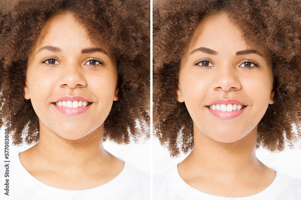 Before after close up african american woman face with acne and problem ...