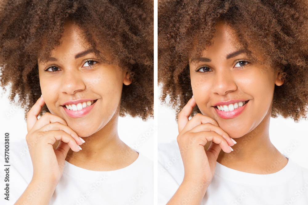 Before after close up african american woman face with acne and problem ...