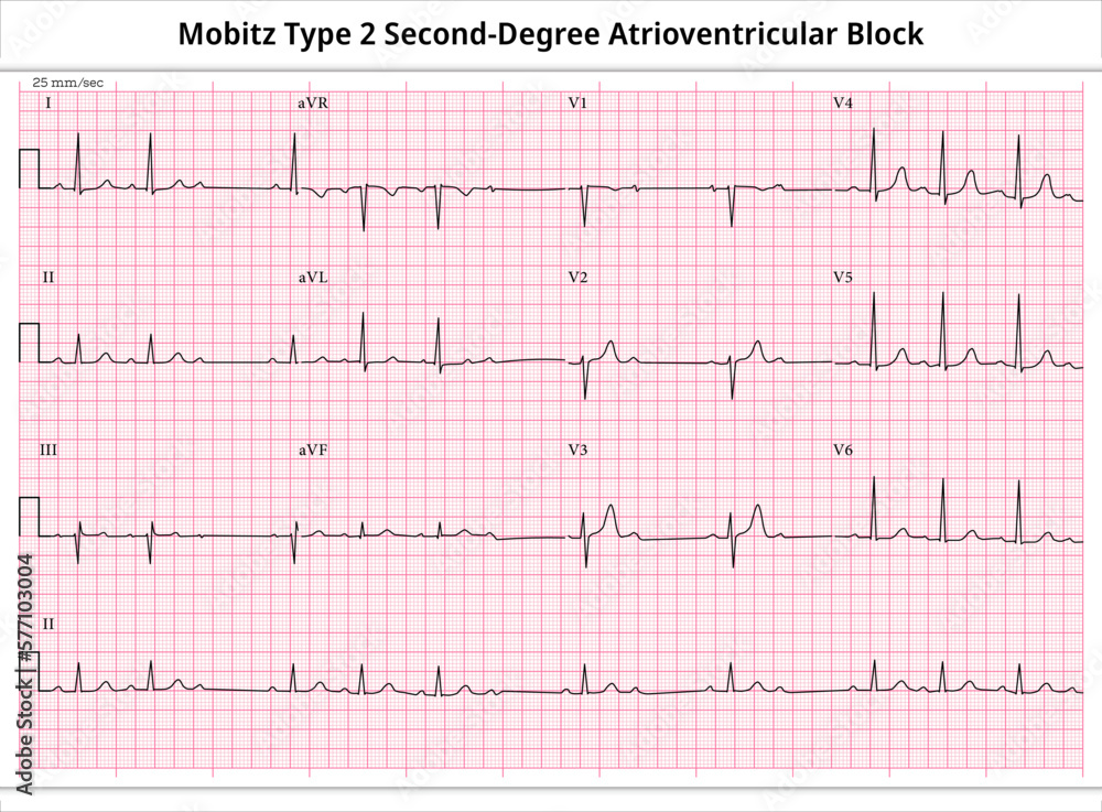 Mobitz Type 2 Second Degree Atrioventricular Block - ECG Paper 12 Lead ...
