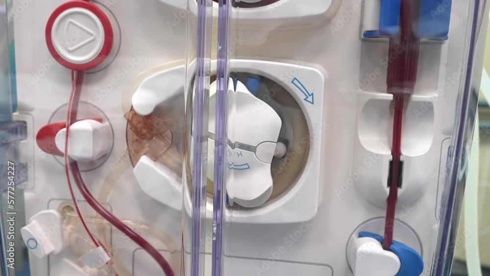 Vidéo Stock Apheresis machine to extract plasma and platelets from ...