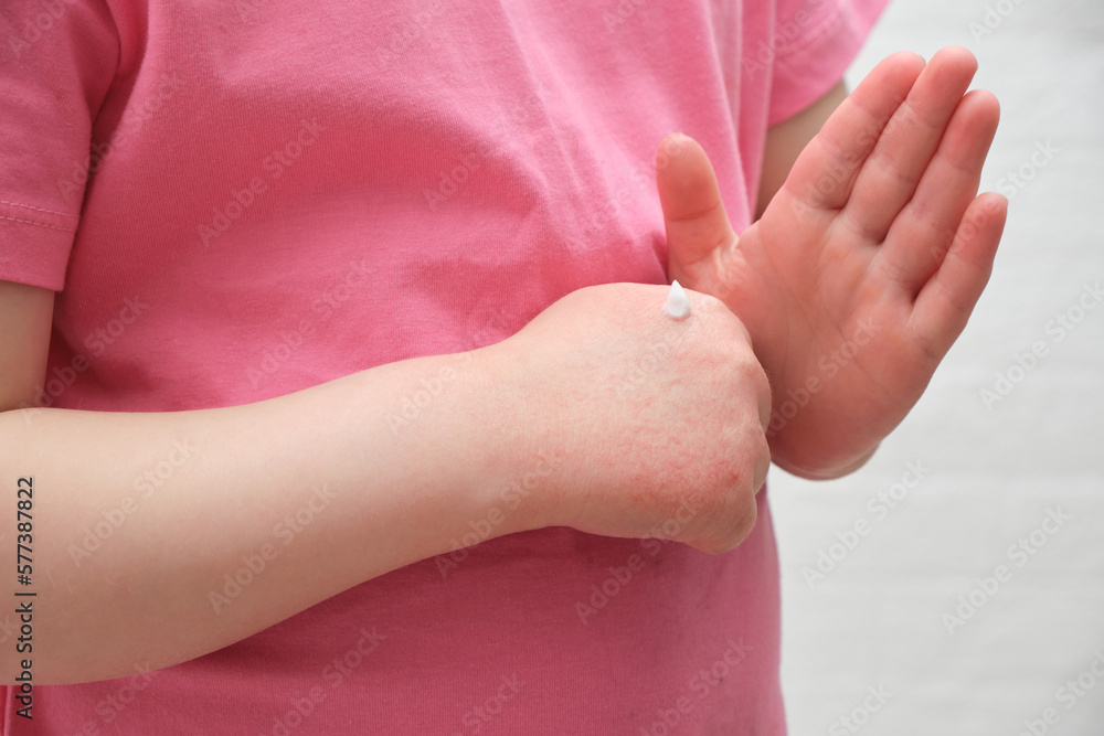 The child scratches atopic skin. Dermatitis, diathesis, allergy on the ...