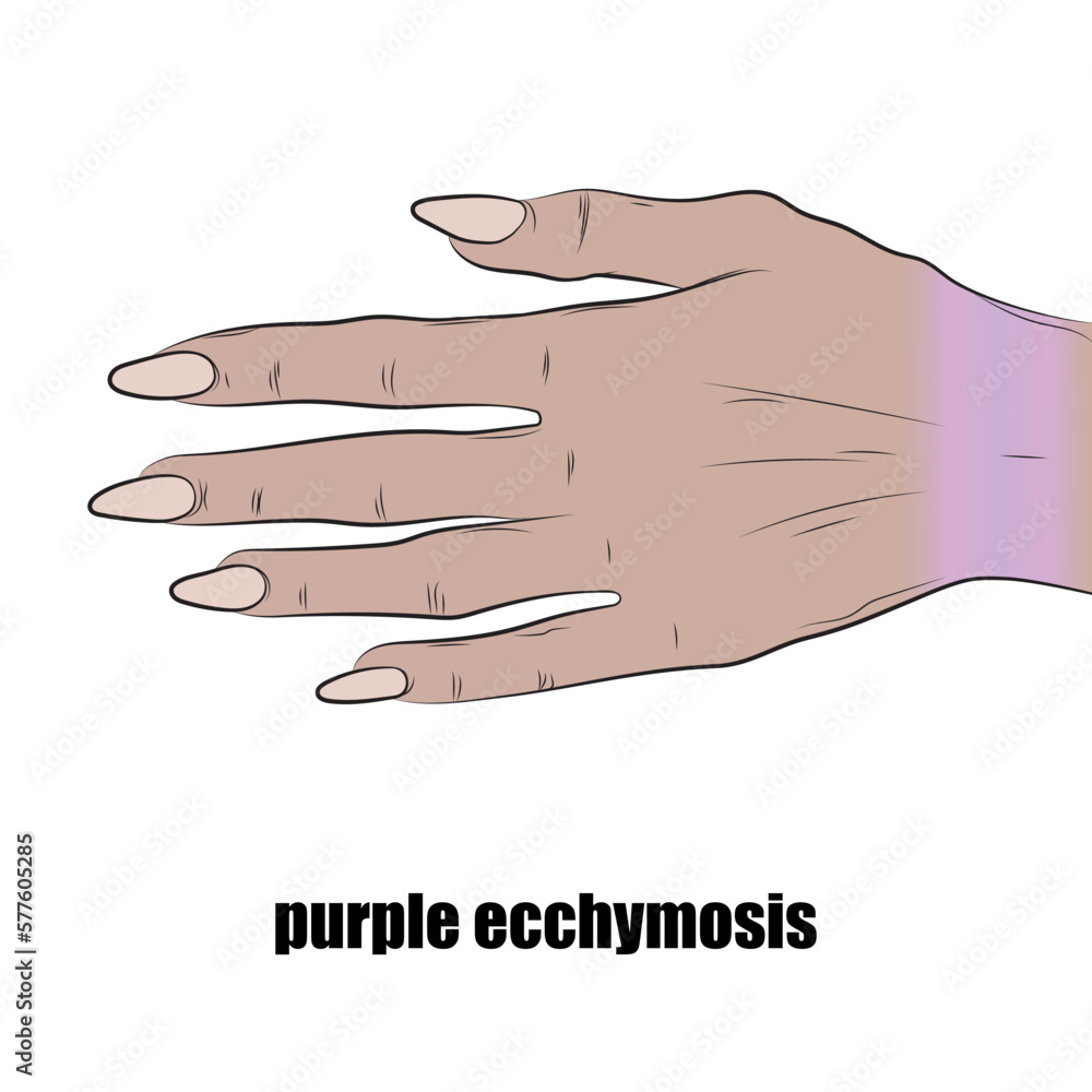 Equimosis, this blood is trapped under the skin, where it is formed ...