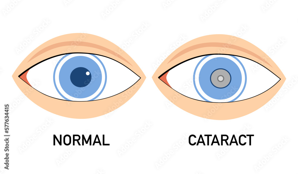 Normal eye and cataract eye in flat design on white background. Stock ...
