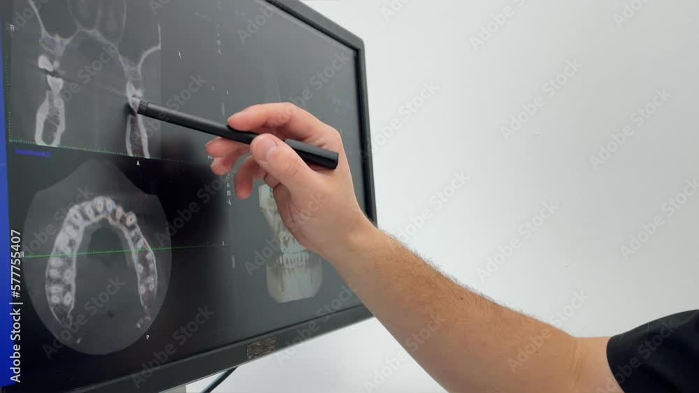 Dentist doctor examines a panoramic x-ray of the jaw on a computer ...