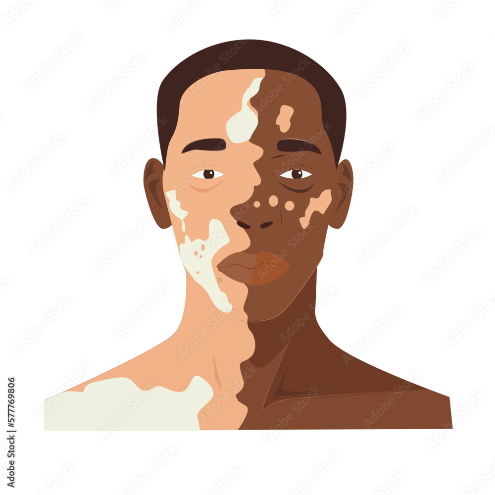 Vitiligo people isolated. Flat vector stock illustration. The concept ...