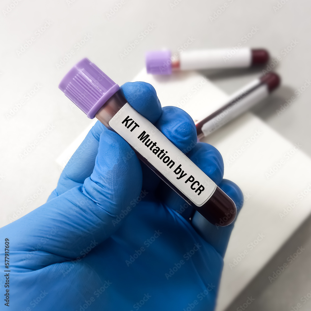 Blood sample for KIT(D816V) mutation by PCR test, to diagnosis of acute ...